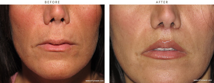 Lip Lift - Sydney Cosmetic Specialists